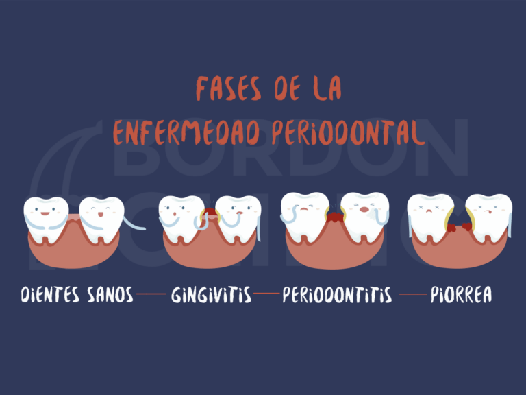 5 Fases Del Tratamiento Periodontal - Clínica Bordonclinic 5 Fases Del Tratamiento Periodontal - Clínica Bordonclinic