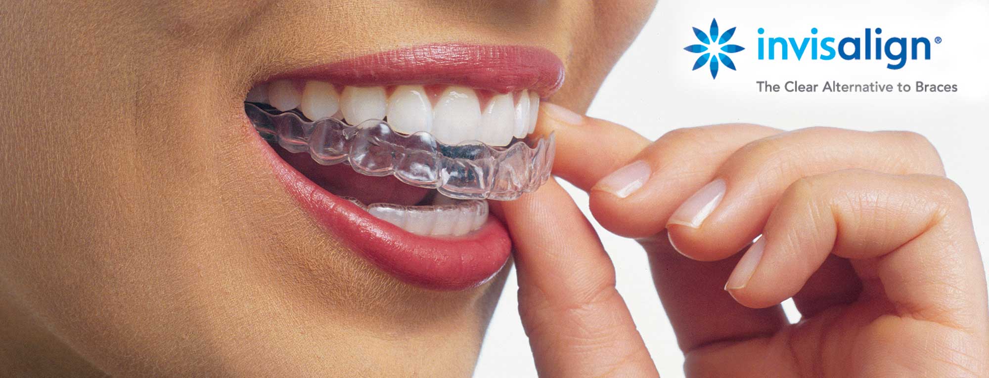 Invisalign En Madrid Ortodoncia Clínica Bordonclinic