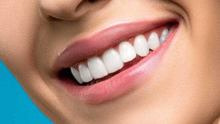 ¿cómo Tener Una Sonrisa Perfecta Bordonclinic